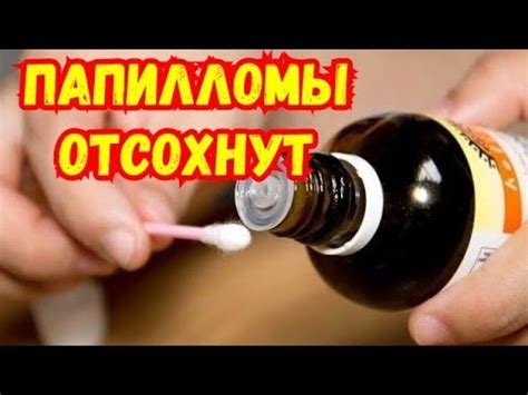 Всего ОДНА БАНОЧКА и папилломы ОТСОХНУТ! Удаление папиллом в домашних ...