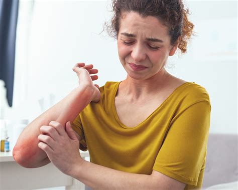 Atopik Dermatit – Alerji ile Yaşam Derneği