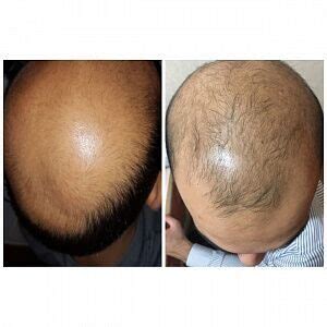 HAIR X "DNA PEPTIDE" FORMULA комплексная терапия для стимуляция роста волос
