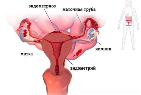 Внутренний эндометриоз матки — что это такое, симптомы и лечение