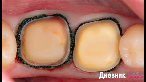 препарирование зубов под коронки восстановление зубов #стоматология # ...