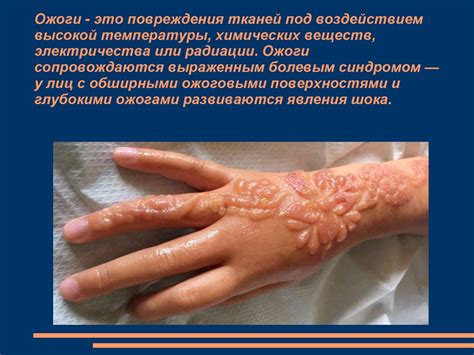 Химические ожоги. Их характеристика. Первая помощь - презентация онлайн
