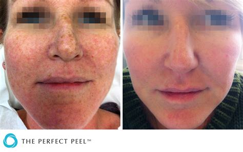The Perfect Peel® | Renew Medical Aesthetics - Cheshire Clinic