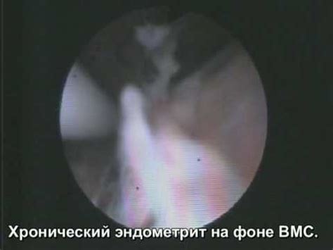 Мирена спираль. Мирена побочные эффекты. - YouTube