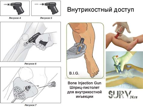 Современный сосудистый доступ. Инфузионная терапия. Гемотрансфизионная ...