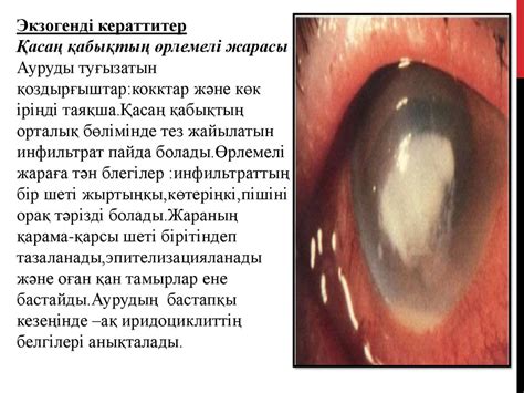 Кератиттердің клиникасы, диагностикасы, емдеуі - презентация онлайн