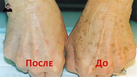 Как выглядят пигментные пятна на лице фото