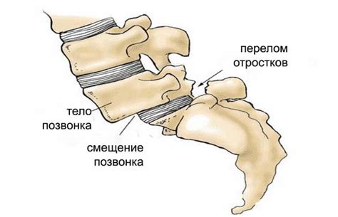 Что такое лордоз? Симптомы, причины и классификация заболевания