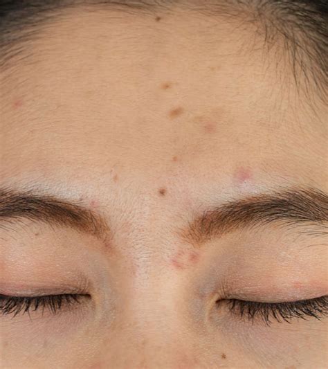 Pimples Around Eyebrows
