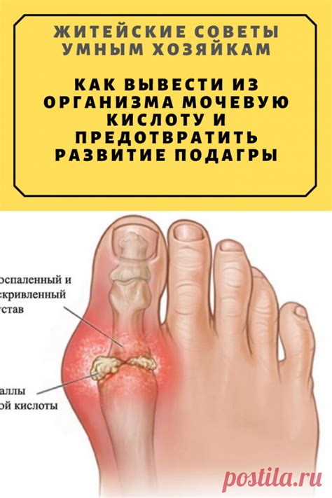 Как вывести из организма мочевую кислоту и предотвратить развитие по ...