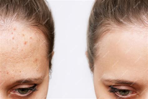 Premium Photo | Cropped shot of young woman's face before after acne treatment on face pimples ...