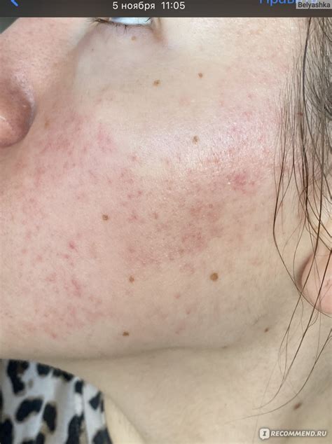 Крем для лица Btpeel От розацеа с азелаиновой кислотой и пребиотиками ...