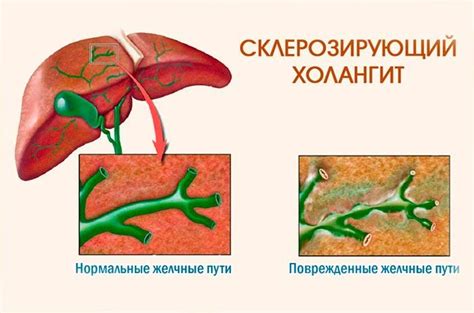 Склерозирующий холангит — что это такое, симптомы, лечение и диагностика