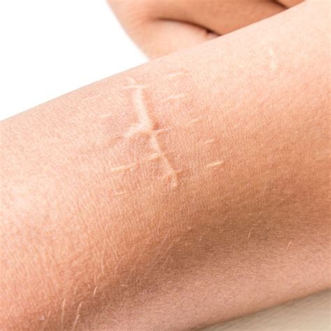 What is a scar, what is its origin, how it influence our lives.