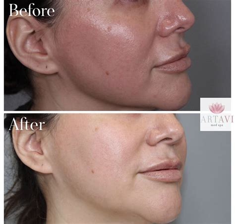 Laser Genesis Acne Treatment in Houston | Artavi Med Spa — Artavi Med Spa