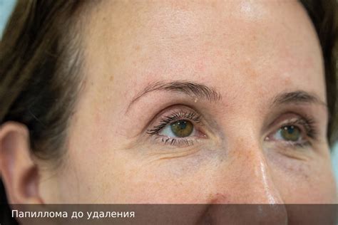 Удаление папиллом по низким ценам в Санкт-Петербурге | Клиника Таурас ...