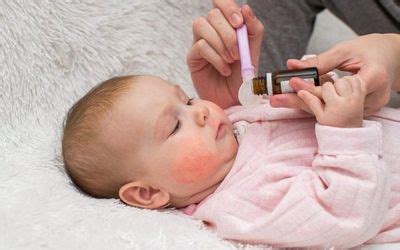 Диатез у грудничка на лице, щеках: как выглядит и чем лечить