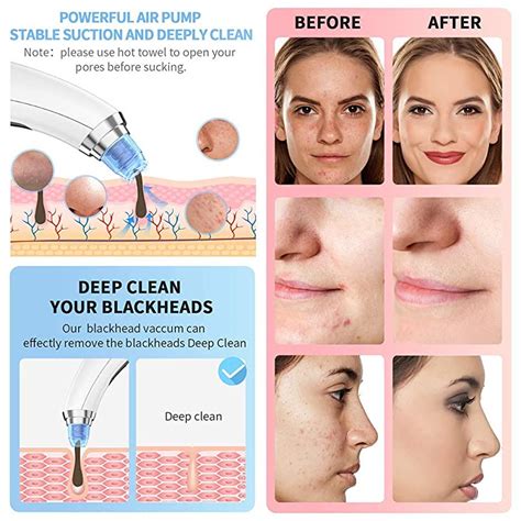 Blackhead Extractor Before And After
