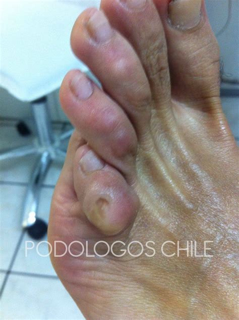 Podólogos Chile - Caso clínico de heloma marginal,...