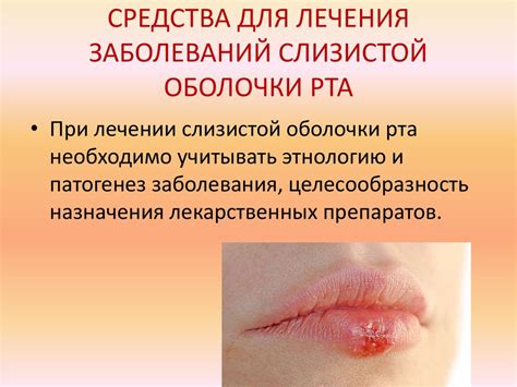 Средства для лечения заболеваний слизистой оболочки рта - презентация ...