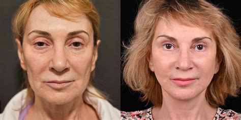 Фото до и после пластики лица | Клиника доктора Гришкяна