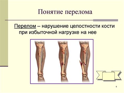 Оказания первой помощи при переломах - презентация онлайн