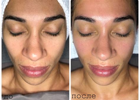 Обучение процедуре Dermaplaning - Дермапланинг: официальный сайт
