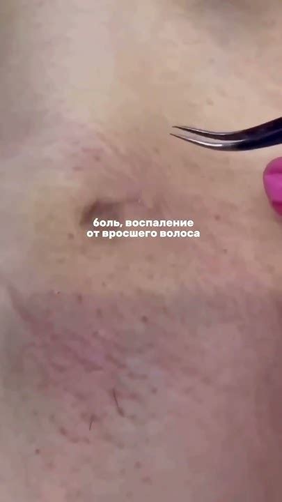 Дарим сертификат на 5000р на лазерную эпиляцию, ссылочка в профиле ️🔥 ...