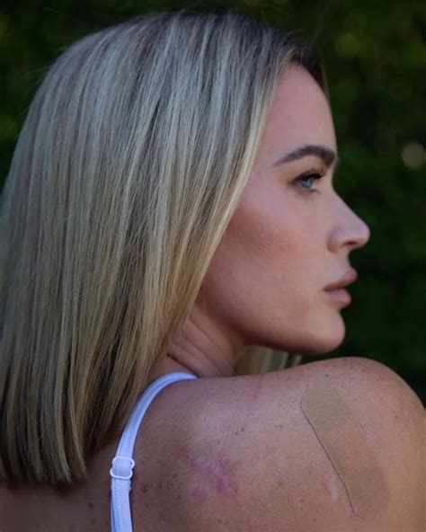Teddi Mellencamp diagnosed with stage 2 melanoma - I Know All News