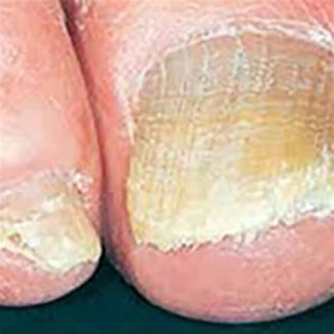 Fungal Nail Treatment – Lyte Laser Clinic