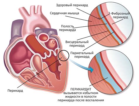 Перикардит сердца - симптомы, что это, клинические рекомендации, лечение