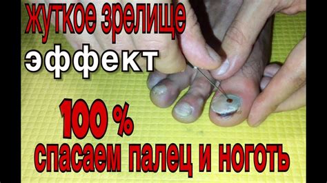 СИЛЬНЫЙ УШИБ ПАЛЬЦА НОГИ. ПОСИНЕЛ НОГОТЬ. СРОЧНО СДЕЛАЙТЕ ЭТО. - YouTube