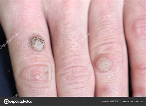 Verrugas Dedo Mano Cerca: fotografía de stock © muro #189202570 ...