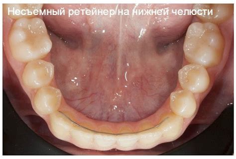 РЕТЕЙНЕРЫ И КАПЫ
