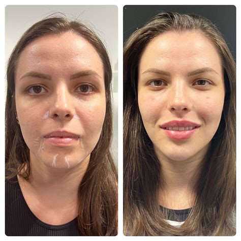 Armonización facial y el plasma en gel, tratamientos en que los ...