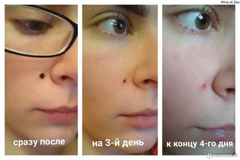 Можно ли удалять выпуклые родинки на лице: какие нужно и опасно ли лазером?