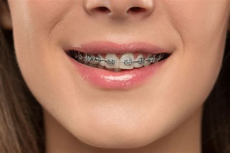 Love brackets