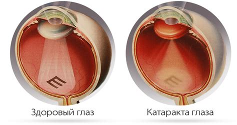 Удаление катаракты и глаукомы одновременно - симптомы, профилактика