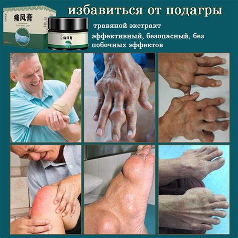 Обезболивающий бальзам от подагры 35 г , артрита и вальгусной ...