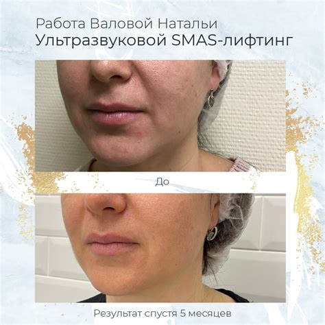 Ультразвуковой SMAS-лифтинг - Услуги