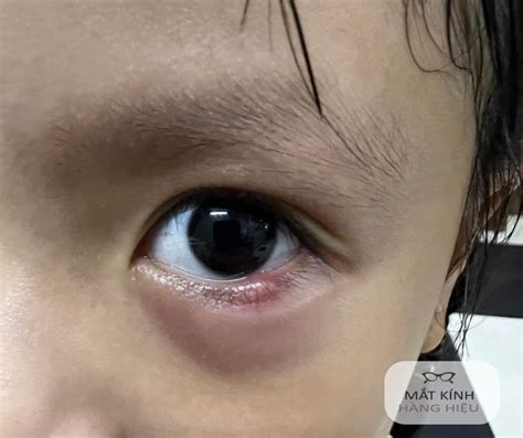 Lẹo mắt: Nguyên nhân, dấu hiệu, cách chữa và cách phòng ngừa