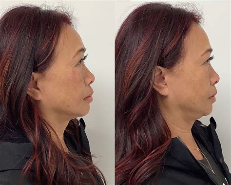 Voluderm Long Island, NY | Queens Voluderm