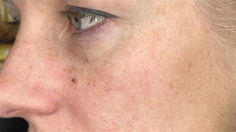 Ретинол против пигментных пятен | DermaQuest | Дзен