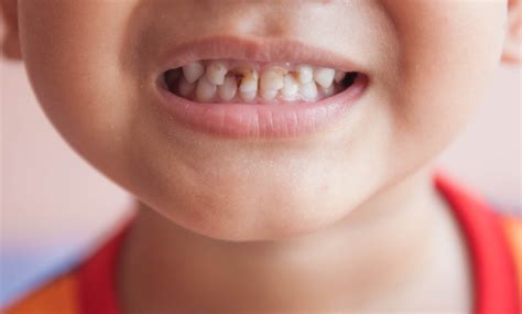Причины и виды кариеса у детей – Стоматологическая клиника «SmileLand ...