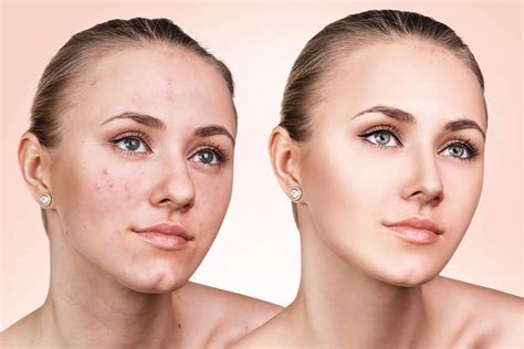 Acne Therapy - Evolution Precision Medicine and Aesthetics