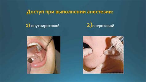 Местная анестезия в стоматологии Местная анестезия anaesthesia