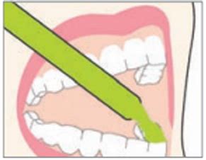 CharmFlex Bite – 덴키스트