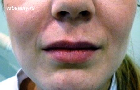 Носогубные складки — vzbeauty.ru
