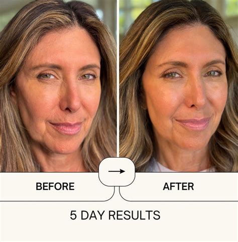 Face Taping Before & After Using Silicone Patches Check Out This 5 Day – Wrinkles Schminkles UK