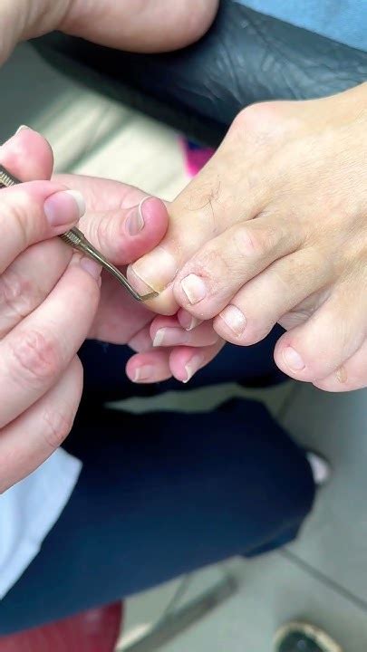 Как правильно укладывать Капалин после удаления вросшего ногтя# ...